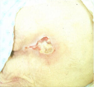 Kennedy Terminal Ulcer Information and Warning Signs